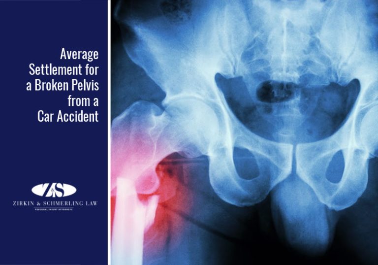 Average Compensation for a Broken Pelvis in a Car Accident